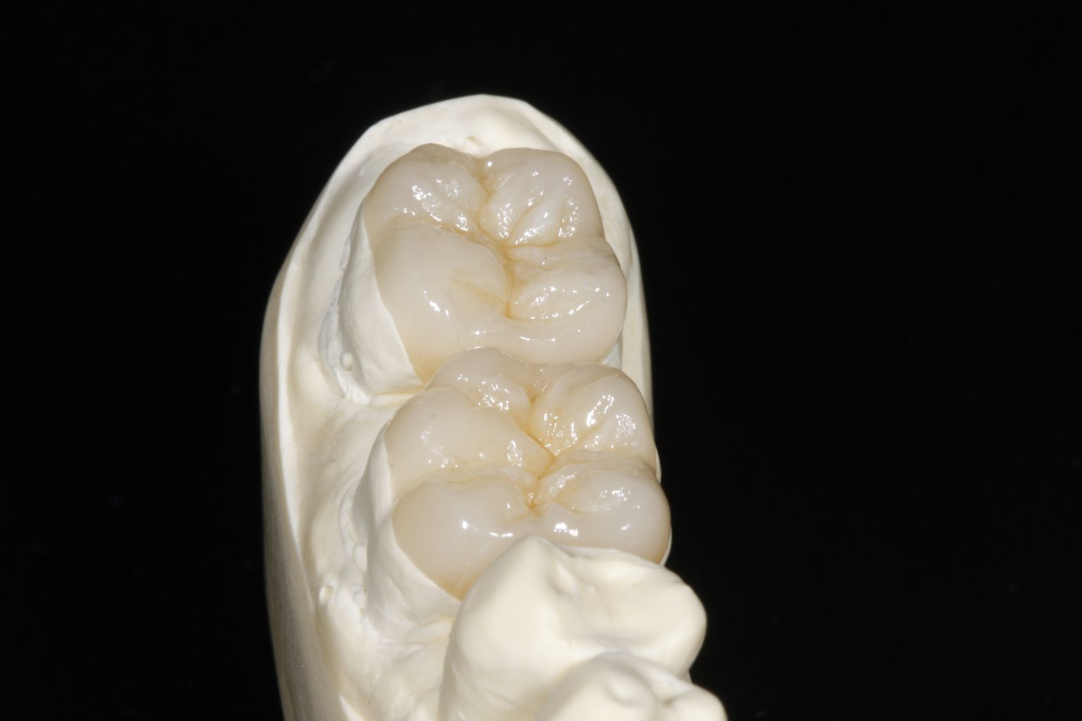 Teilkronen e.max – Zahntechnisches Laboratorium Harald Göbel GmbH