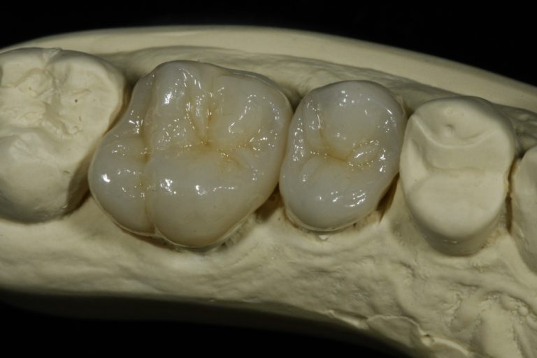 Teilkronen e.max – Zahntechnisches Laboratorium Harald Göbel GmbH